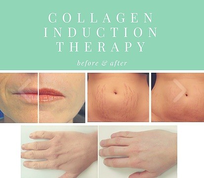Collagen Induction – Simply Glow Advanced Skincare